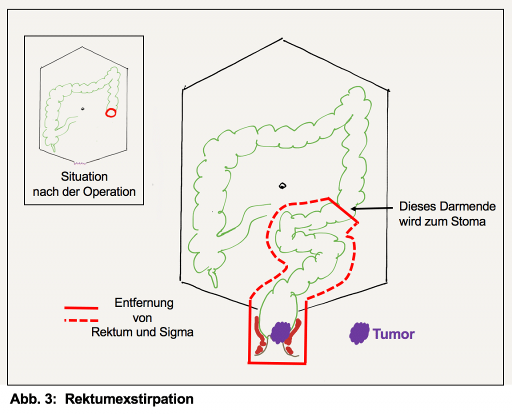 Stoma Rückoperation: Experteninterview - Physiotherapie Dr. Hochwimmer