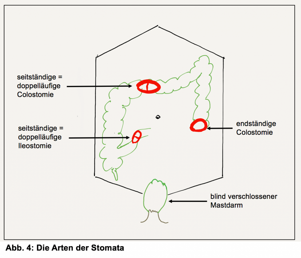 Stoma Rückoperation: Experteninterview - Physiotherapie Dr. Hochwimmer
