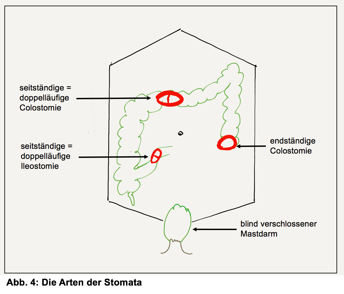 Stoma Rückoperation: Experteninterview - Physiotherapie Dr. Hochwimmer